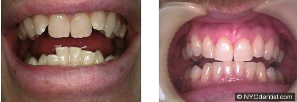 Removable Dental Braces – Before and After Photos